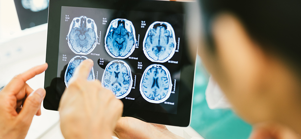 Brain Tumors | UConn Health